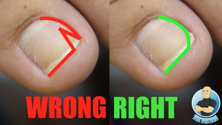 Are Wondering How To Fix Curved Toenails Heres Our Simple Solution